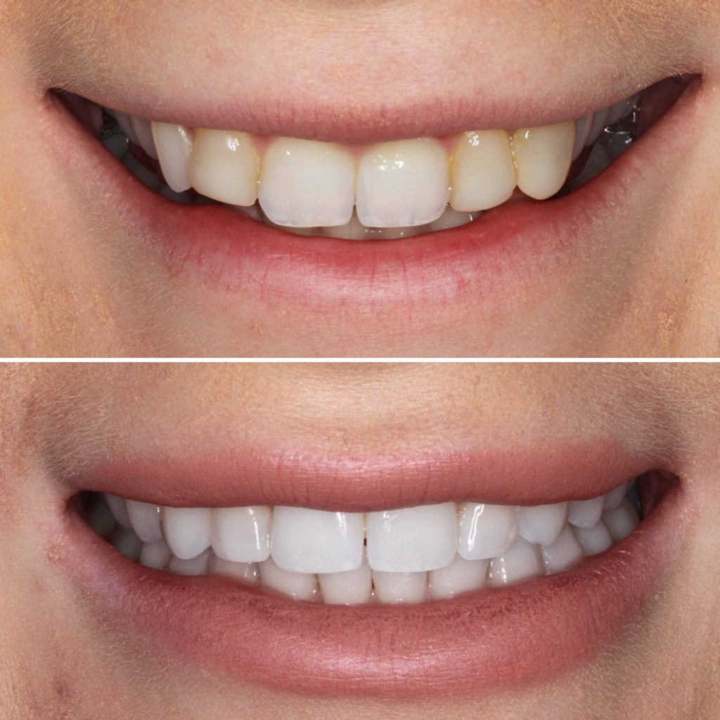 Smile Makeover | Before & After | Cosmetic Dentistry Results BOOK ONLINE