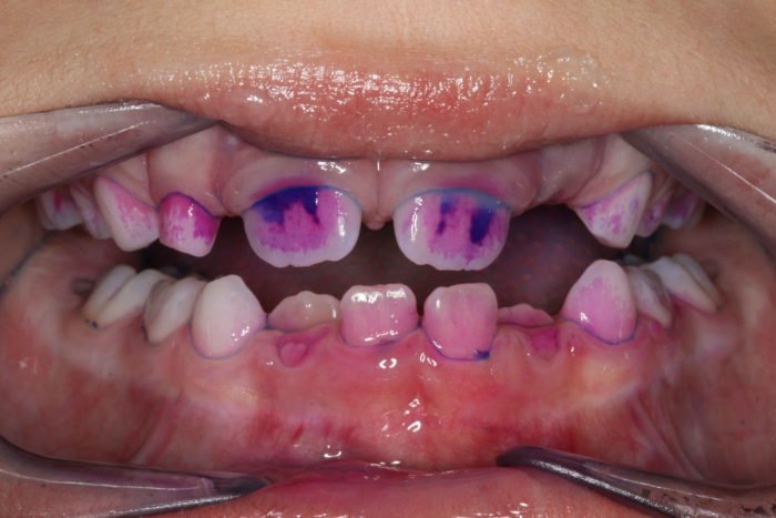 Disclosing Tablets | Do they work? | Healthy Smiles NW3