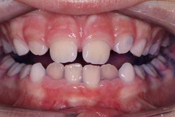 Disclosing Tablets | Do they work? | Healthy Smiles NW3