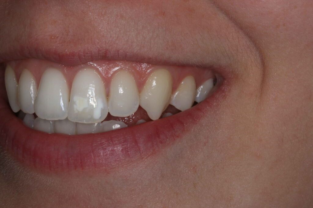 Icon - Remove white spots on teeth | Does it work? | NW3