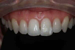 Icon - Remove white spots on teeth | Does it work? | NW3