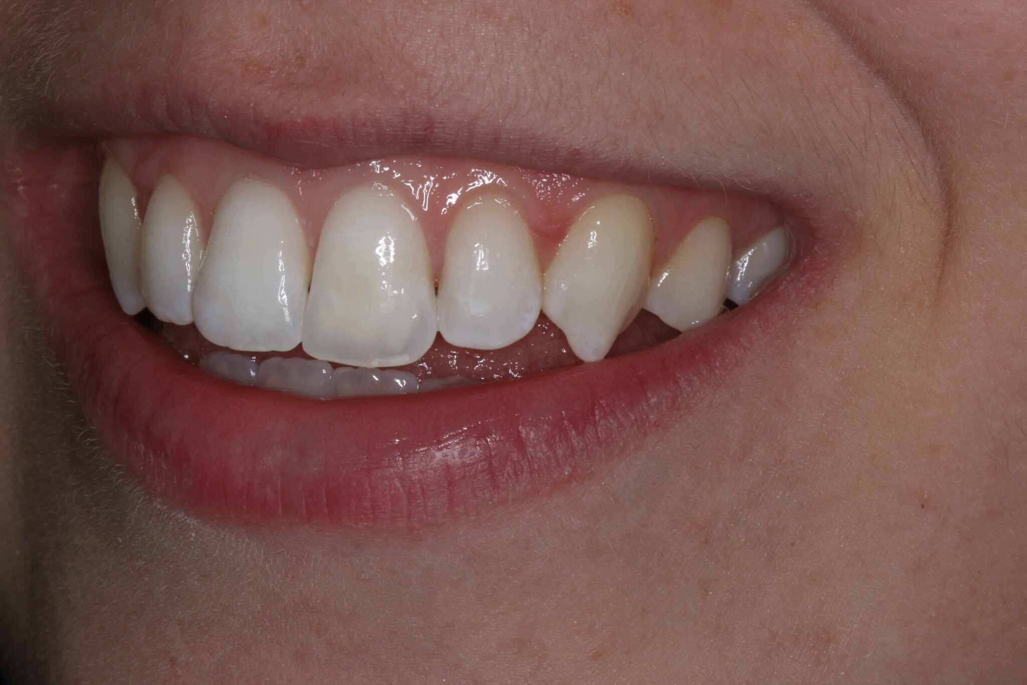 Icon - Remove white spots on teeth | Does it work? | NW3